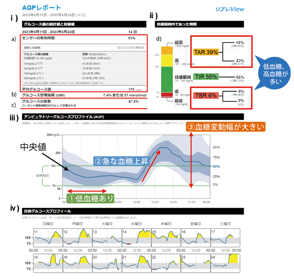 4．CGMデータを活用したインスリン治療の最適化 | 糖尿病・内分泌プラクティスWeb